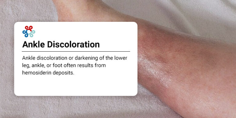 Ankle Discoloration: A Sign of Vein Disease - Vein Care Center in New ...