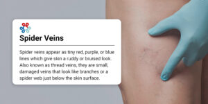 Spider Veins and Varicose Veins: What’s the Difference? - Vein Care ...
