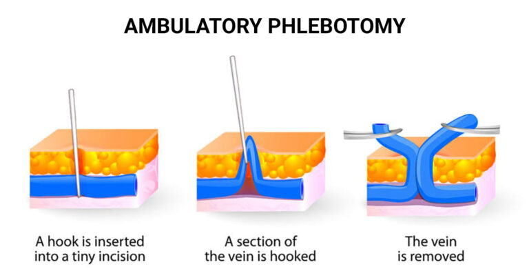 Ambulatory Phlebectomy in NYC & NJ | Vein Care Center