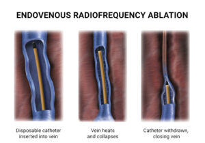 Endovenous Radiofrequency Ablation (RFA) in NYC & NJ