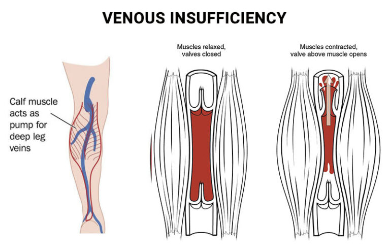 Venous Insufficiency Treatment in NYC & NJ | Vein Care Center